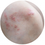 Skin Conditions - Canadian Dermatology Association