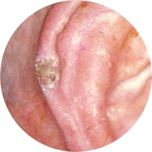 Skin Conditions - Canadian Dermatology Association