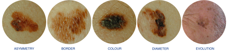 Melanoma - Canadian Dermatology Association