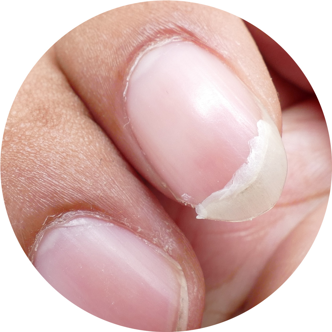 Brittle Nails - Canadian Dermatology Association