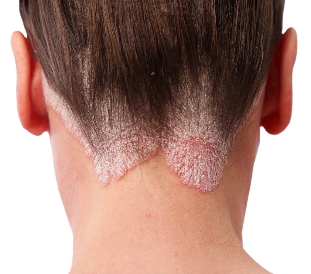 Psoriasis - Canadian Dermatology Association